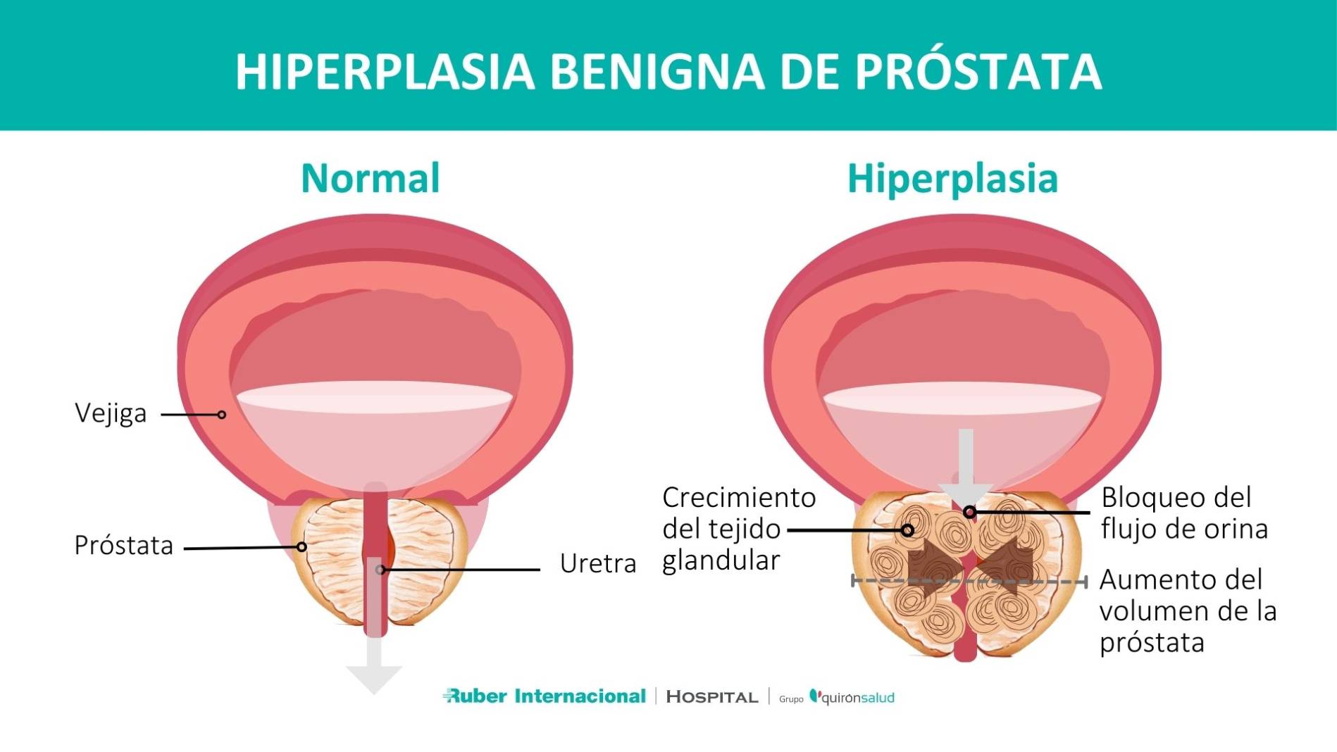 Hiperplasia benigna de próstata: tratamiento mediante enucleación con láser de holmio